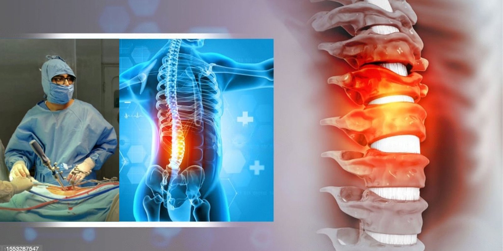 Spine Surgery - Apex Hospital-Varanasi
